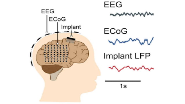 ELECTROCORTICOGRAPHY(ECOG)