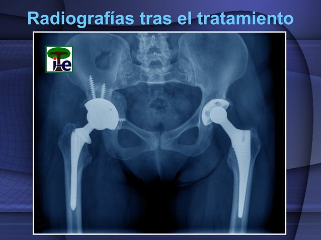 Aflojamiento de un cotilo no cementado | PPT