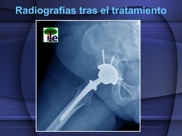 Aflojamiento de un cotilo no cementado | PPT | Surgery | Medical Health