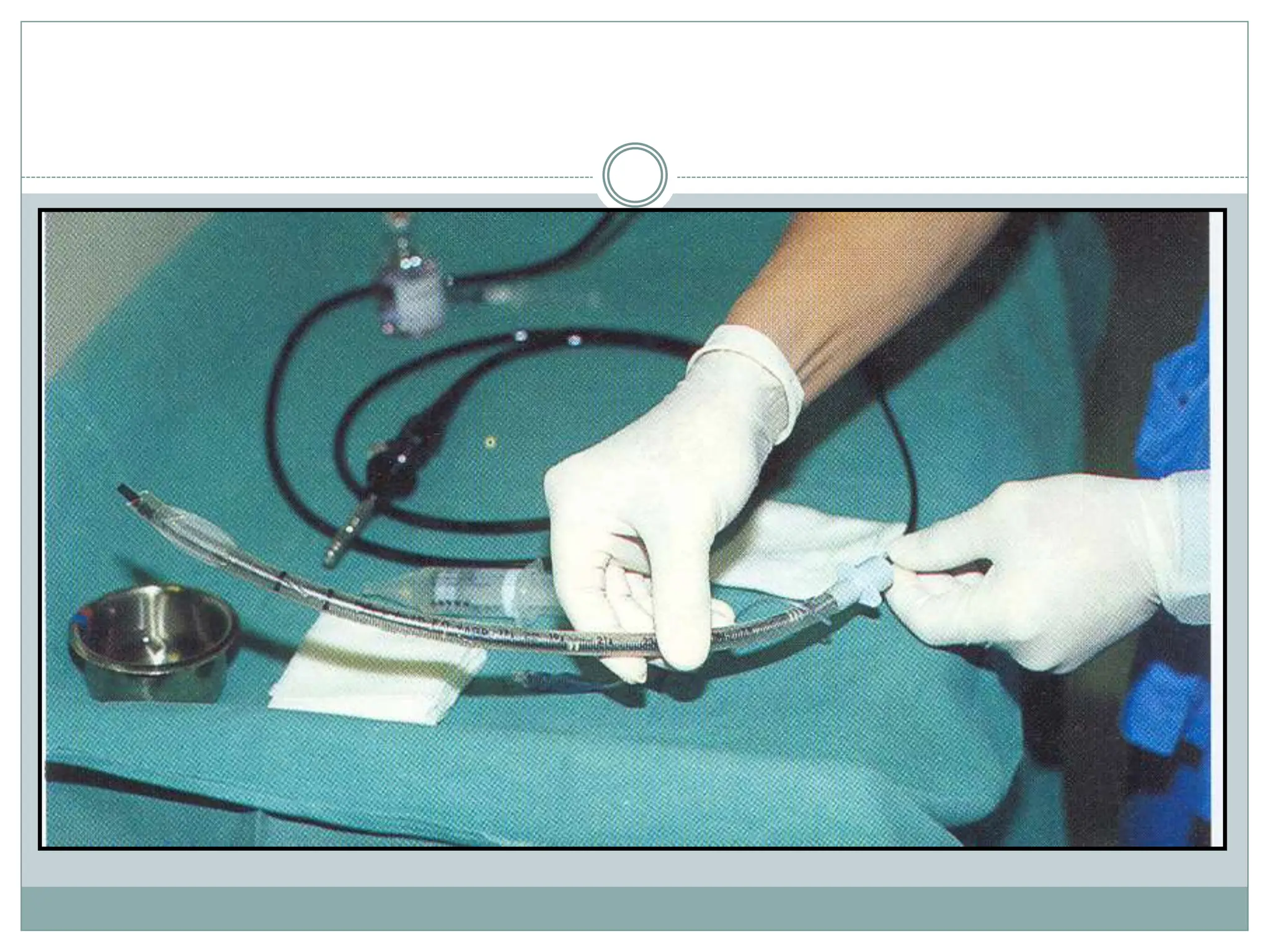 Awake fibrioptic Intubation in difficult airway | PPTX