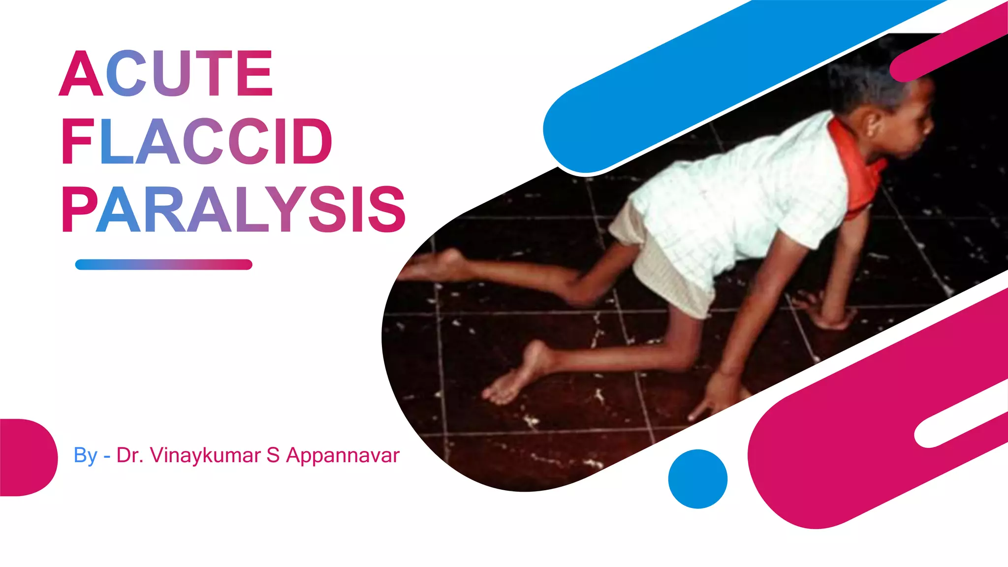 Acute flaccid paralysis , Polio , Transverse myelitis, AFP survillence ...