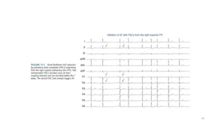 Atrial Fibrilasi Panduan PERKI | PPTX