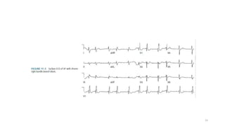 Atrial Fibrilasi Panduan PERKI | PPTX