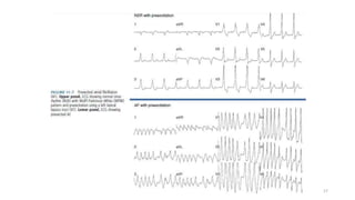Atrial Fibrilasi Panduan PERKI | PPTX