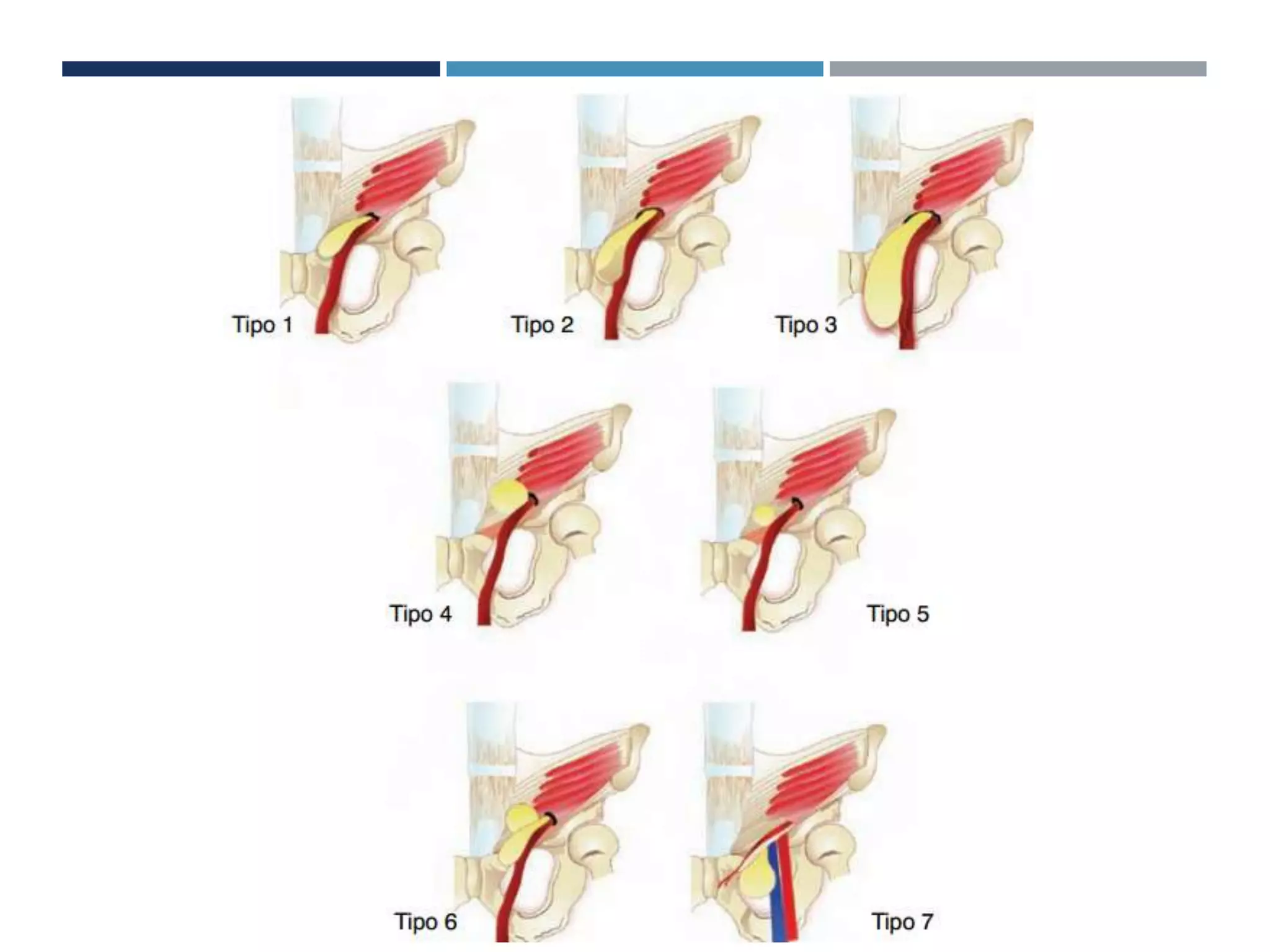 Anatomia y fisiologia de la region inguinal | PPTX