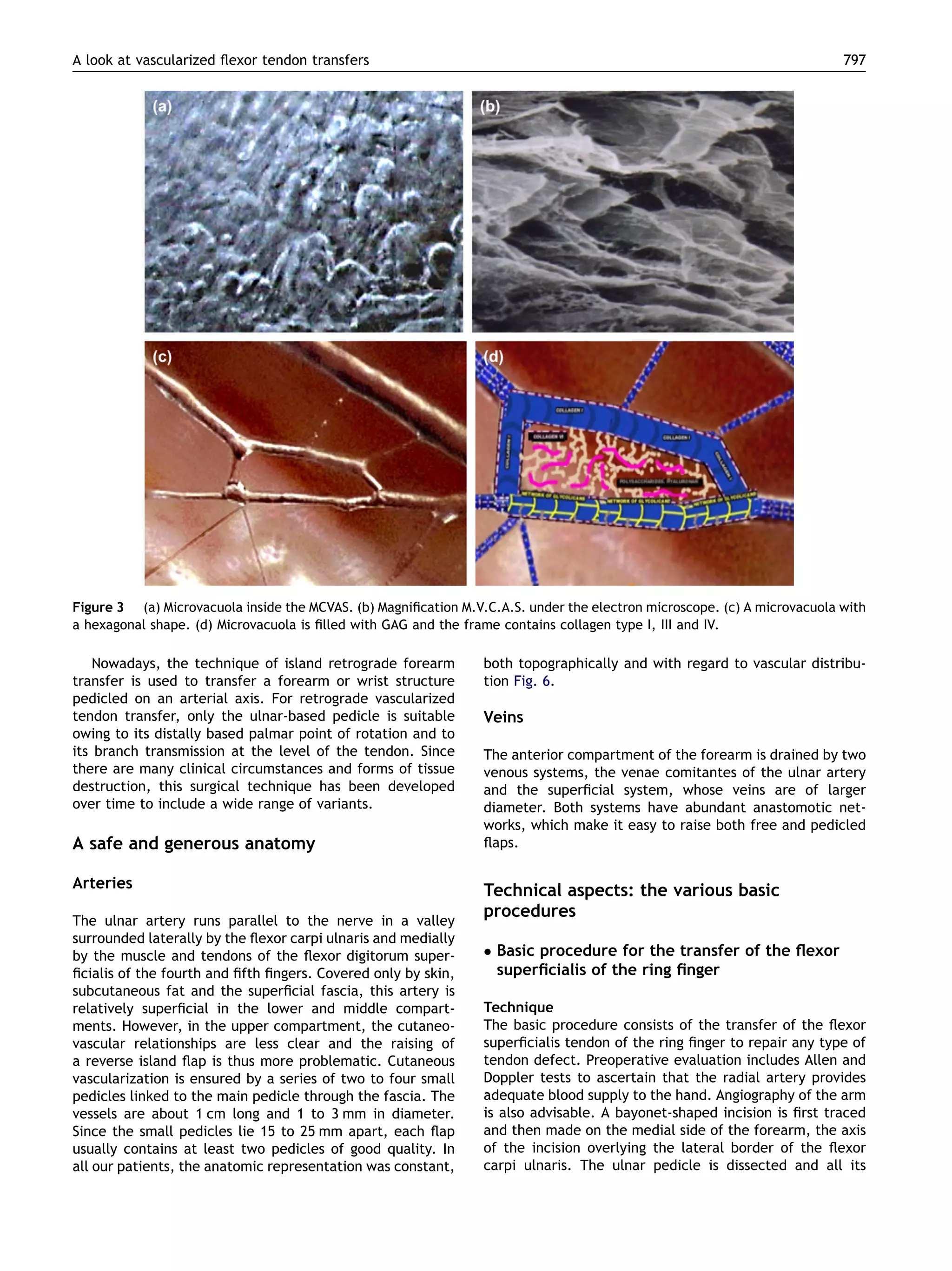A fresh look at vascularized flexor tendon transfers | PDF