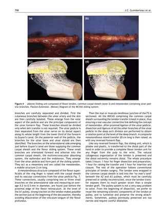 A fresh look at vascularized flexor tendon transfers | PDF