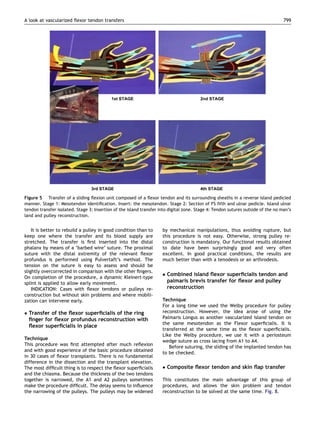 A fresh look at vascularized flexor tendon transfers | PDF