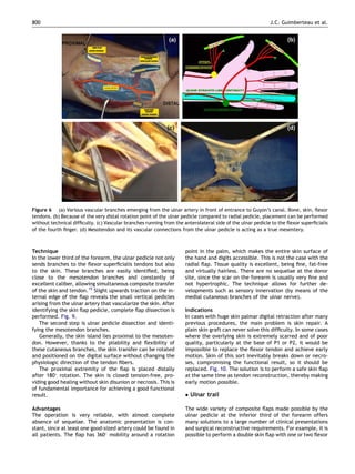 A fresh look at vascularized flexor tendon transfers | PDF