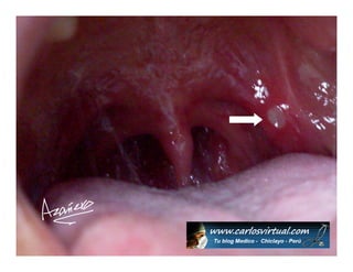 Aftas Orales | PPT