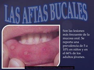 Aftas bucales | PPTX