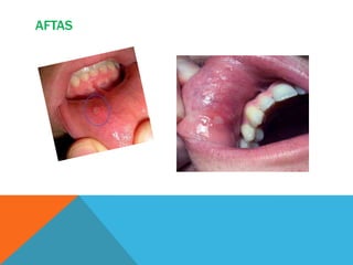 Aftas orales | PPTX