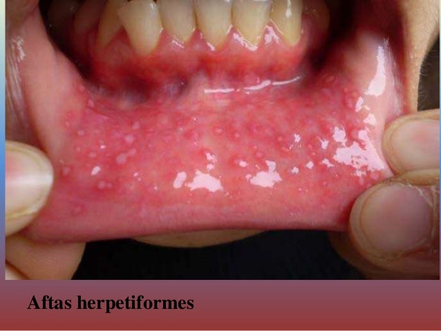 (2013-04-18) Aftas orales recidivantes (ppt)