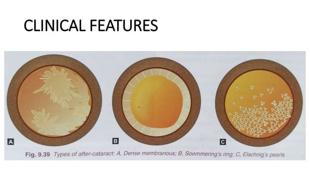 After cataract.pptx | Free Download