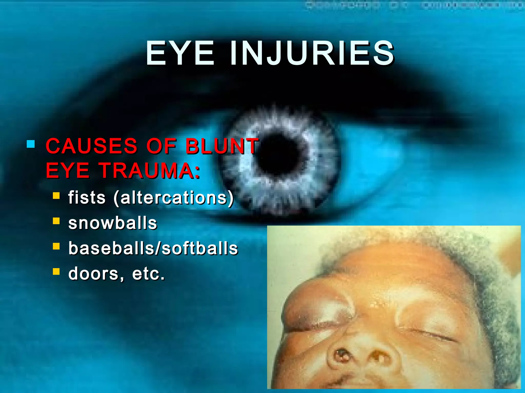 EYE TRAUMA | PPT