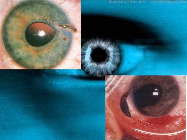 EYE TRAUMA | PPT | Eye and Vision Conditions | Diseases and Conditions