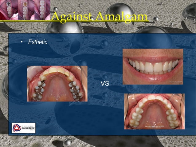 Against Amalgam | PPT