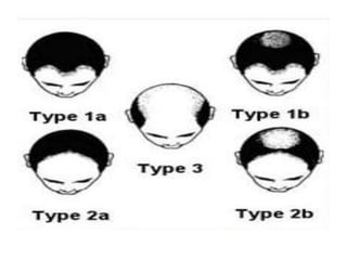 Grading Staging in Androgenetic Alopecia (Male Pattern Baldness) by ...