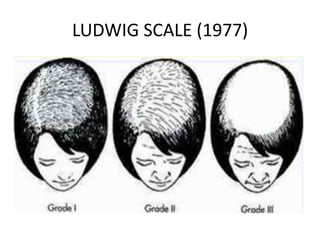 Grading Staging in Androgenetic Alopecia (Male Pattern Baldness) by ...