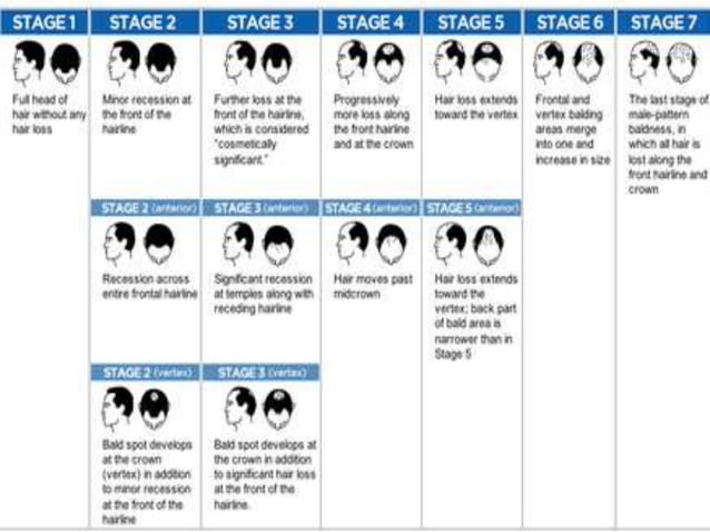Grading Staging in Androgenetic Alopecia (Male Pattern Baldness) by ...