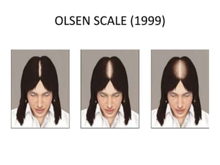 Grading Staging in Androgenetic Alopecia (Male Pattern Baldness) by ...