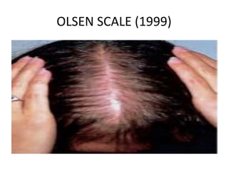 Grading Staging in Androgenetic Alopecia (Male Pattern Baldness) by ...