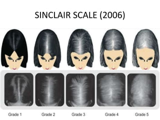 Grading Staging in Androgenetic Alopecia (Male Pattern Baldness) by ...