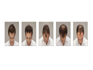 Grading Staging in Androgenetic Alopecia (Male Pattern Baldness) by ...