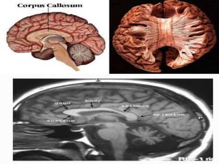 Agenesis of The Corpus Callosum ACC | PPTX | Brain and Nervous System ...