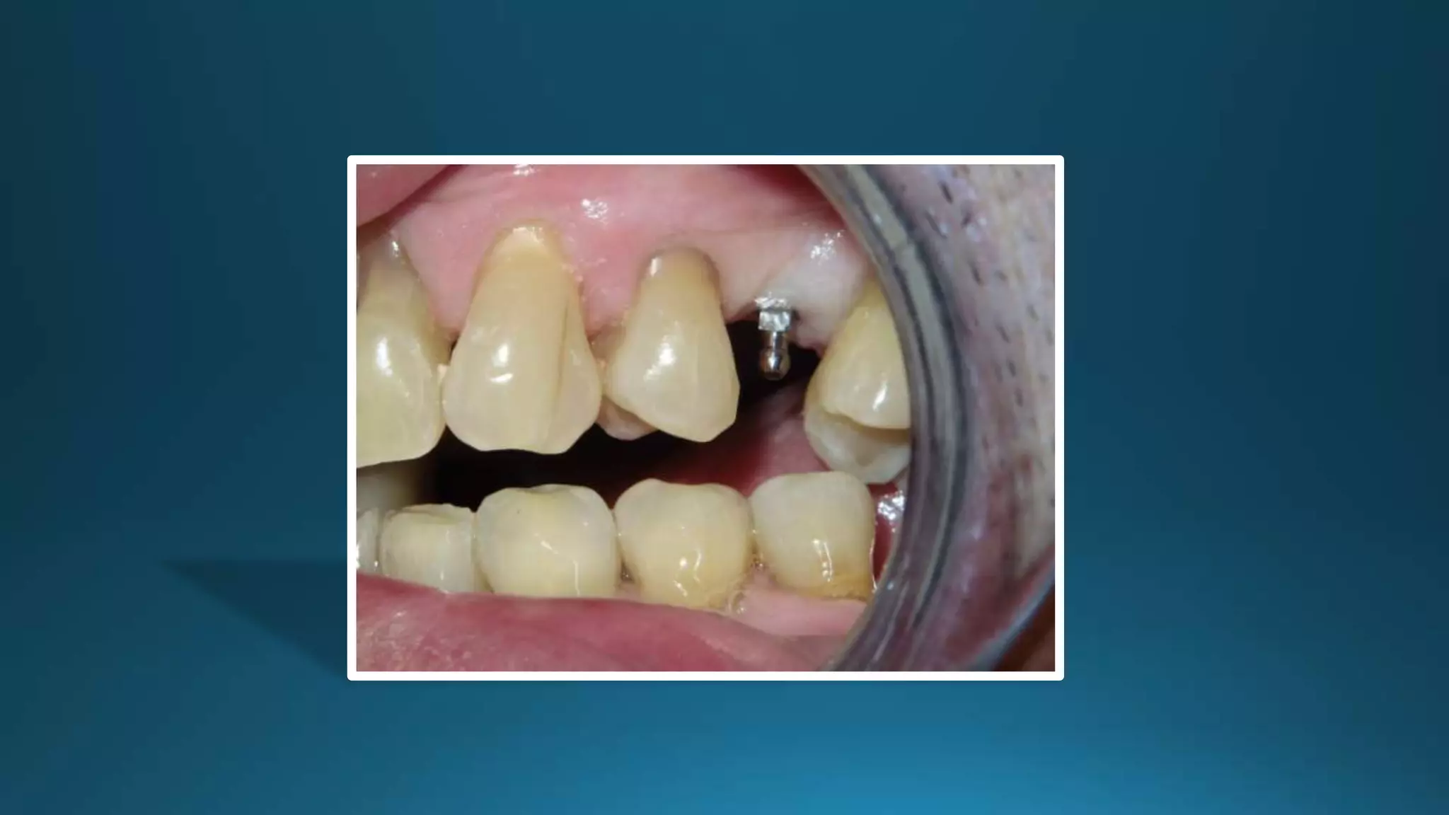 AGD Shatkin FIRST Single Stage Implant and Crown Restoration | PPT