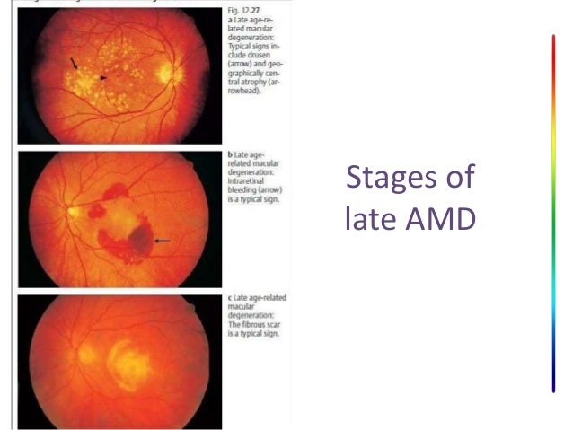 Age related macular degeneration