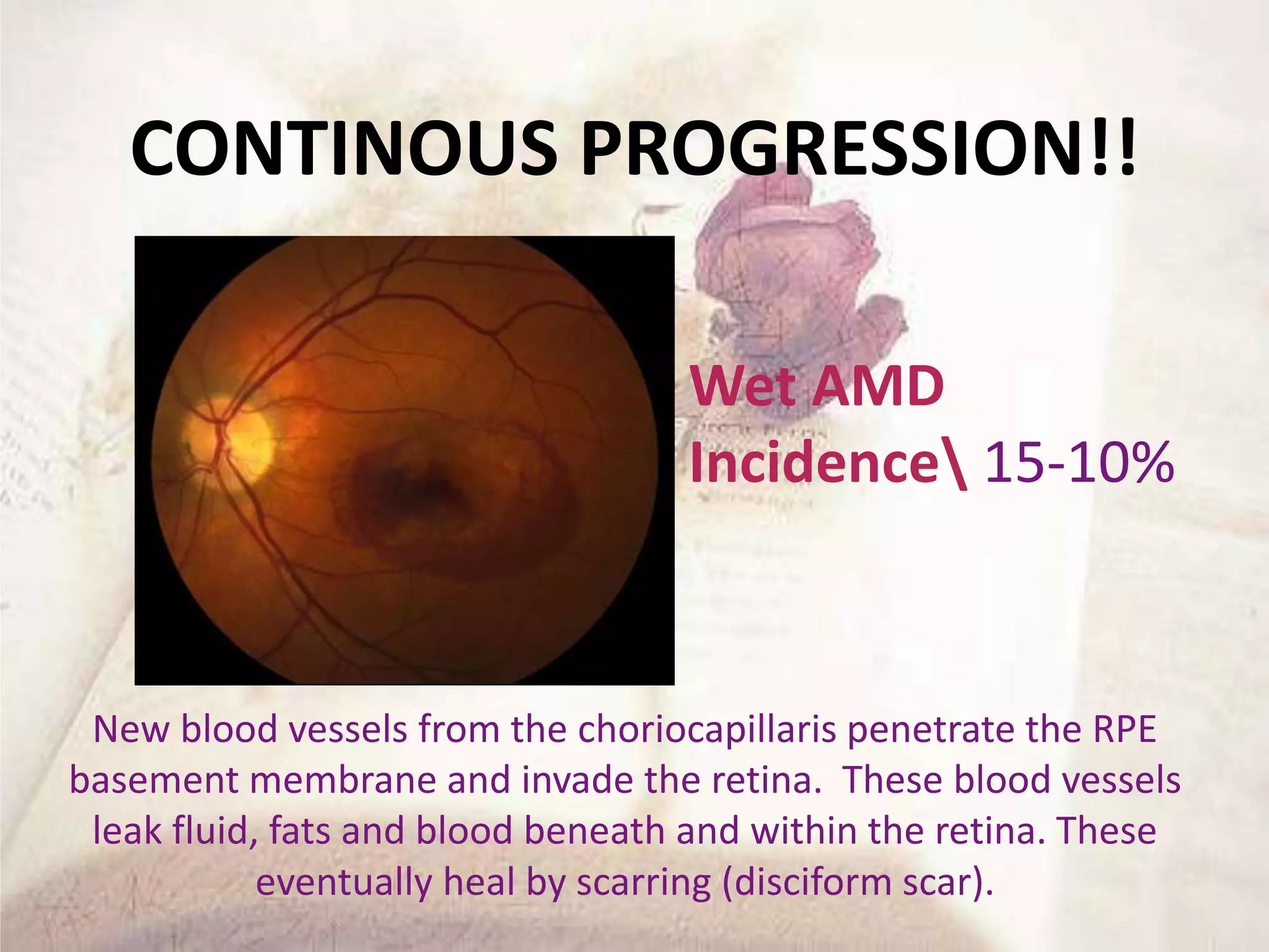 Age-Related Macular Degeneration | PPTX