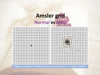 Age-Related Macular Degeneration | PPTX