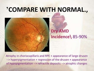 Age-Related Macular Degeneration | PPTX
