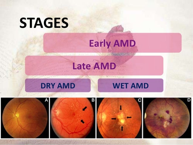 Age-Related Macular Degeneration
