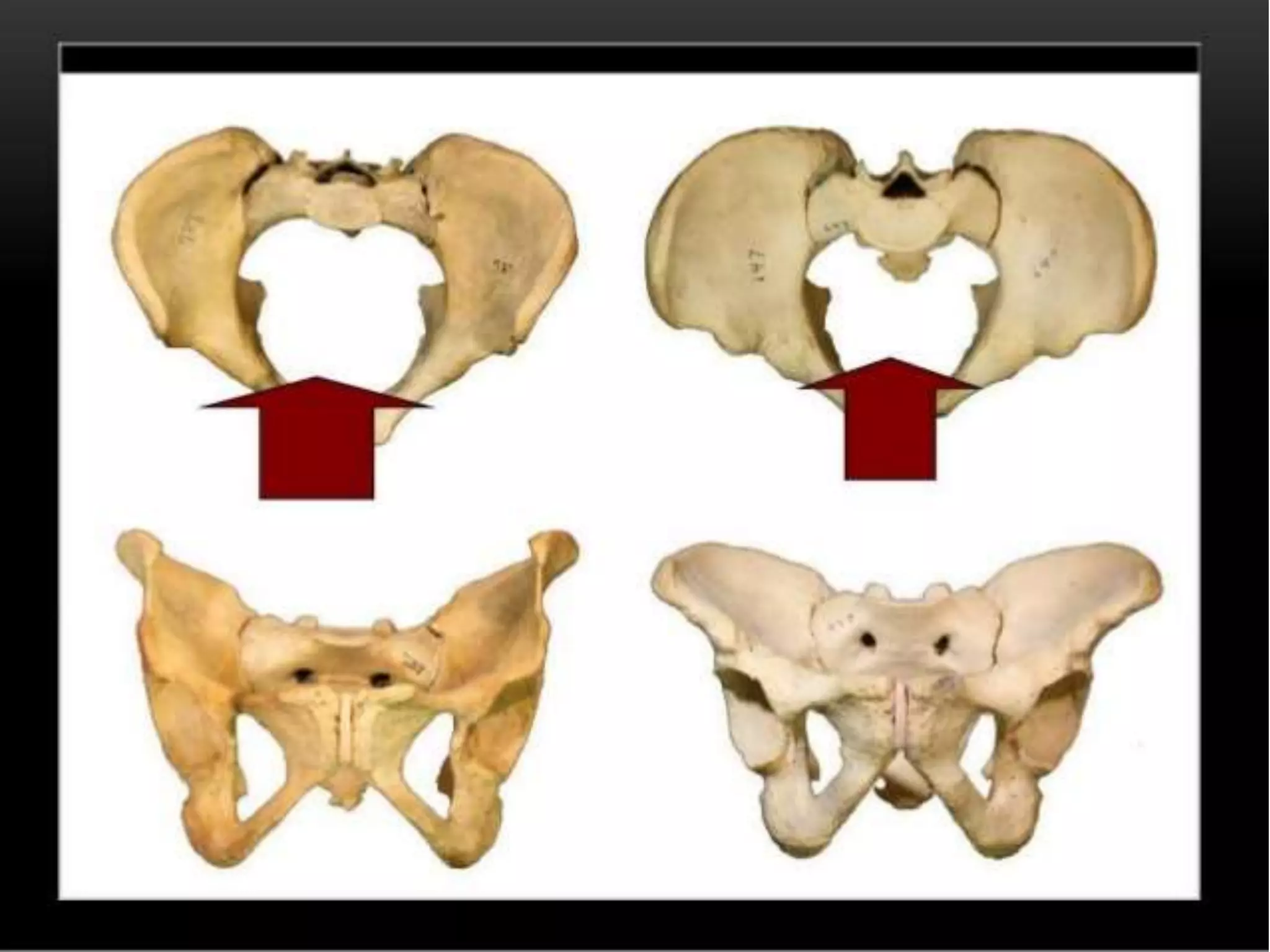 Age and sex ditermination from pelvis | PPTX