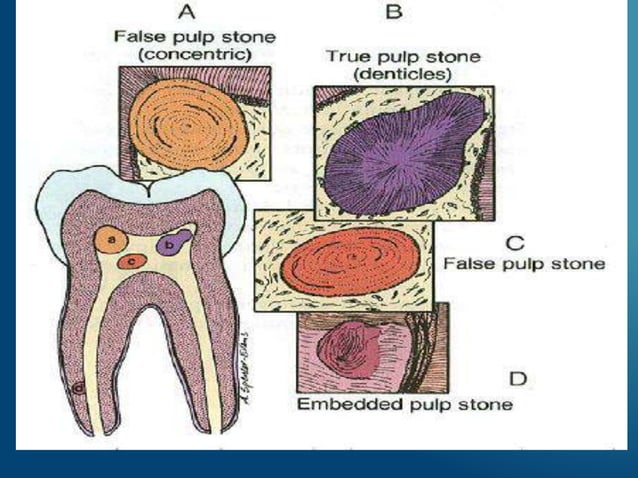 Age changes in enamel, dentin and pulp1.pptx | Dental Health | Diseases ...