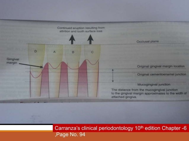 "AGE CHANGES IN PERIODONTIUM" | PPT | Dental Health | Diseases and ...