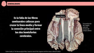 Agenesia del cuerpo calloso | PDF