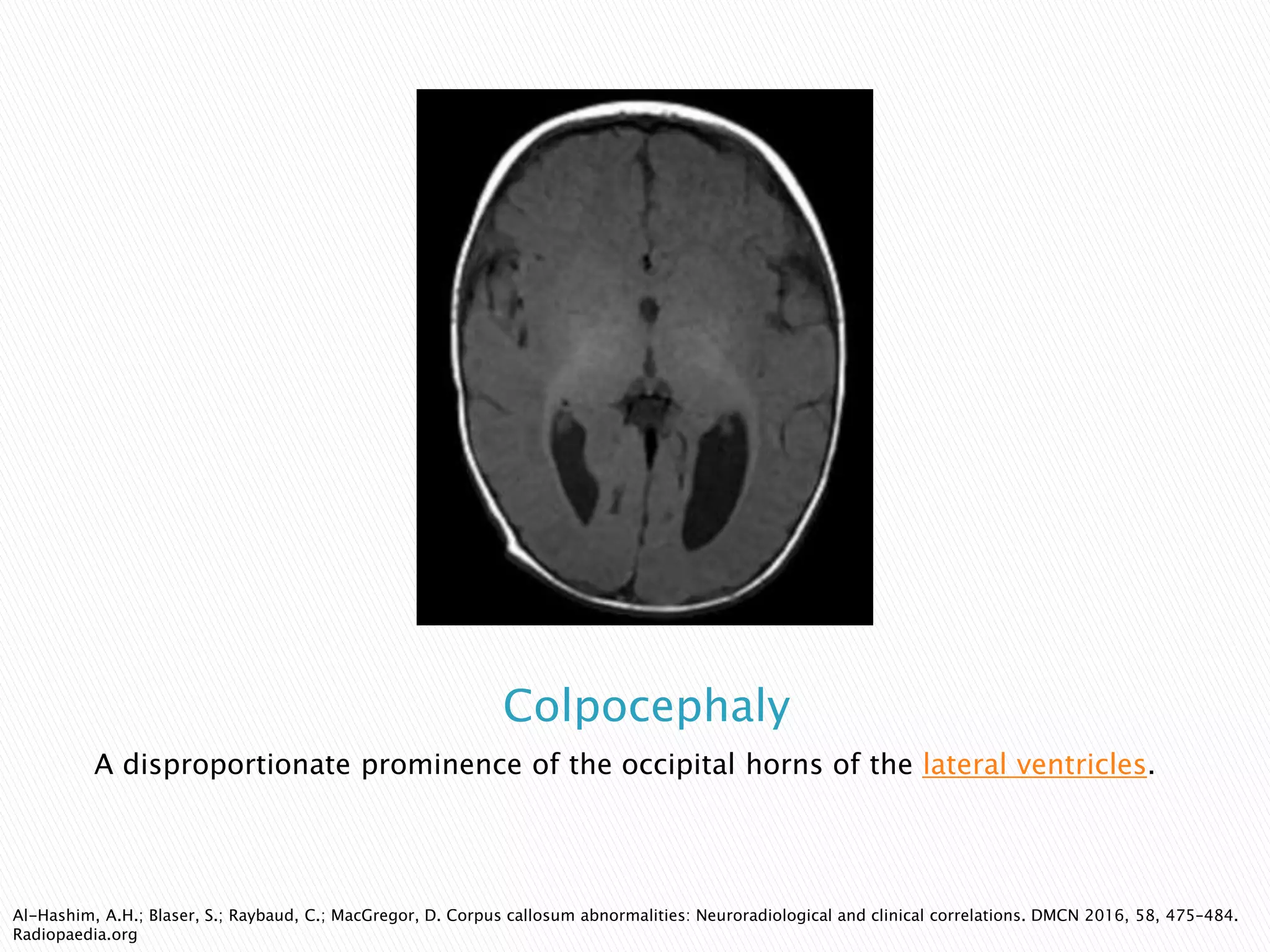 Agenesis Corpus Callosum | PPT