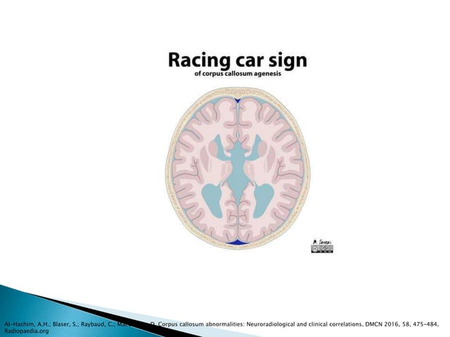 Agenesis Corpus Callosum | PPT