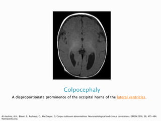 Agenesis Corpus Callosum | PPT