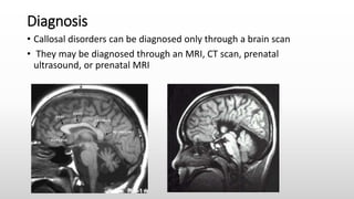Agenesis of corpus callosum | PPTX