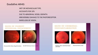 AGE REALTED MACULAR DEGENERATIONs. pptxx | PPTX