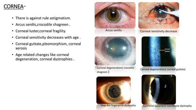 AGE RELATED CHANGES IN EYE(Eyelids, Conjunctiva, cornea, iris, pupil ...