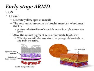 Age related macular degeneration from Optometrist Point of View | PPT