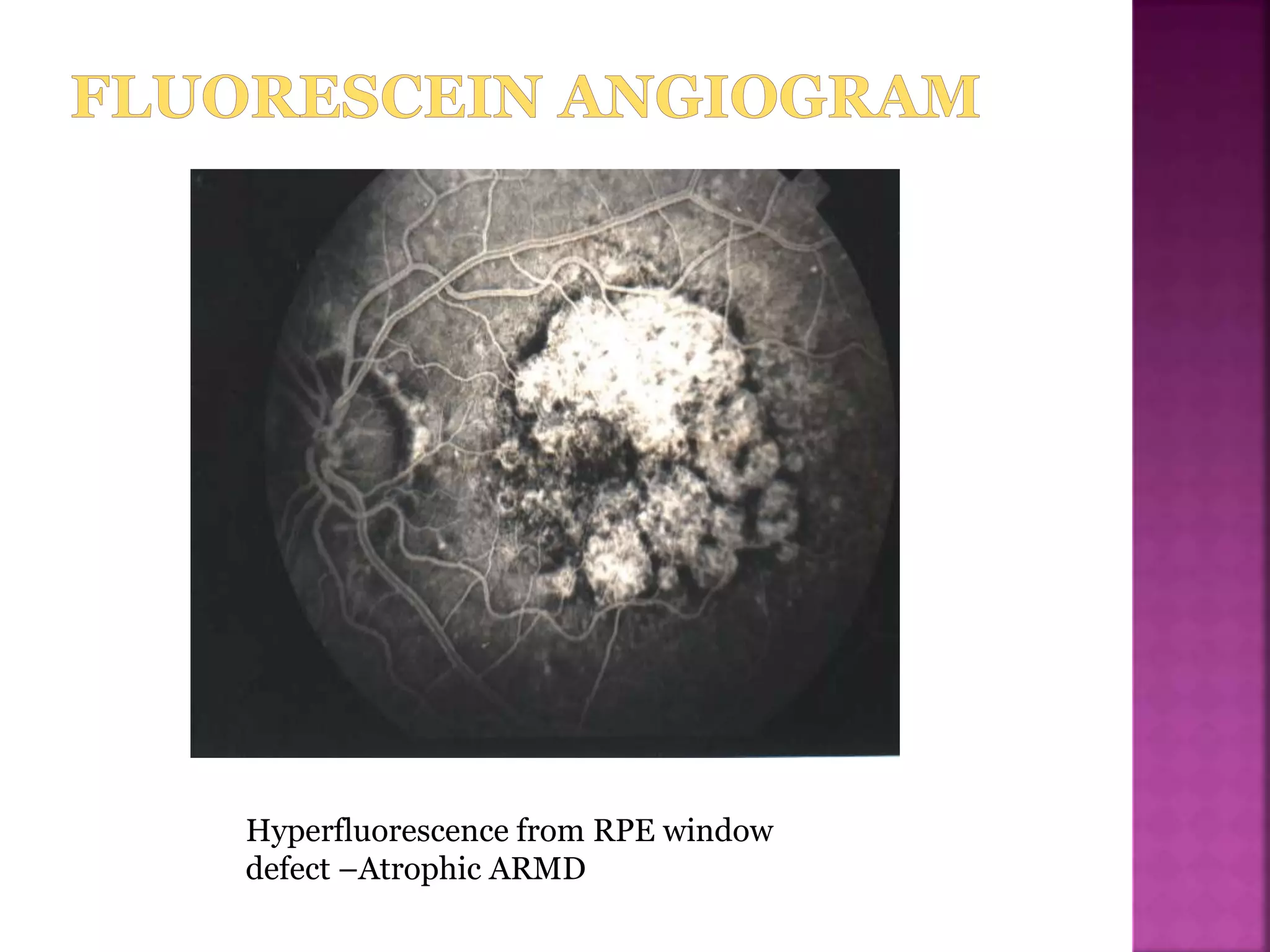 Age related macular degeneration | PPTX