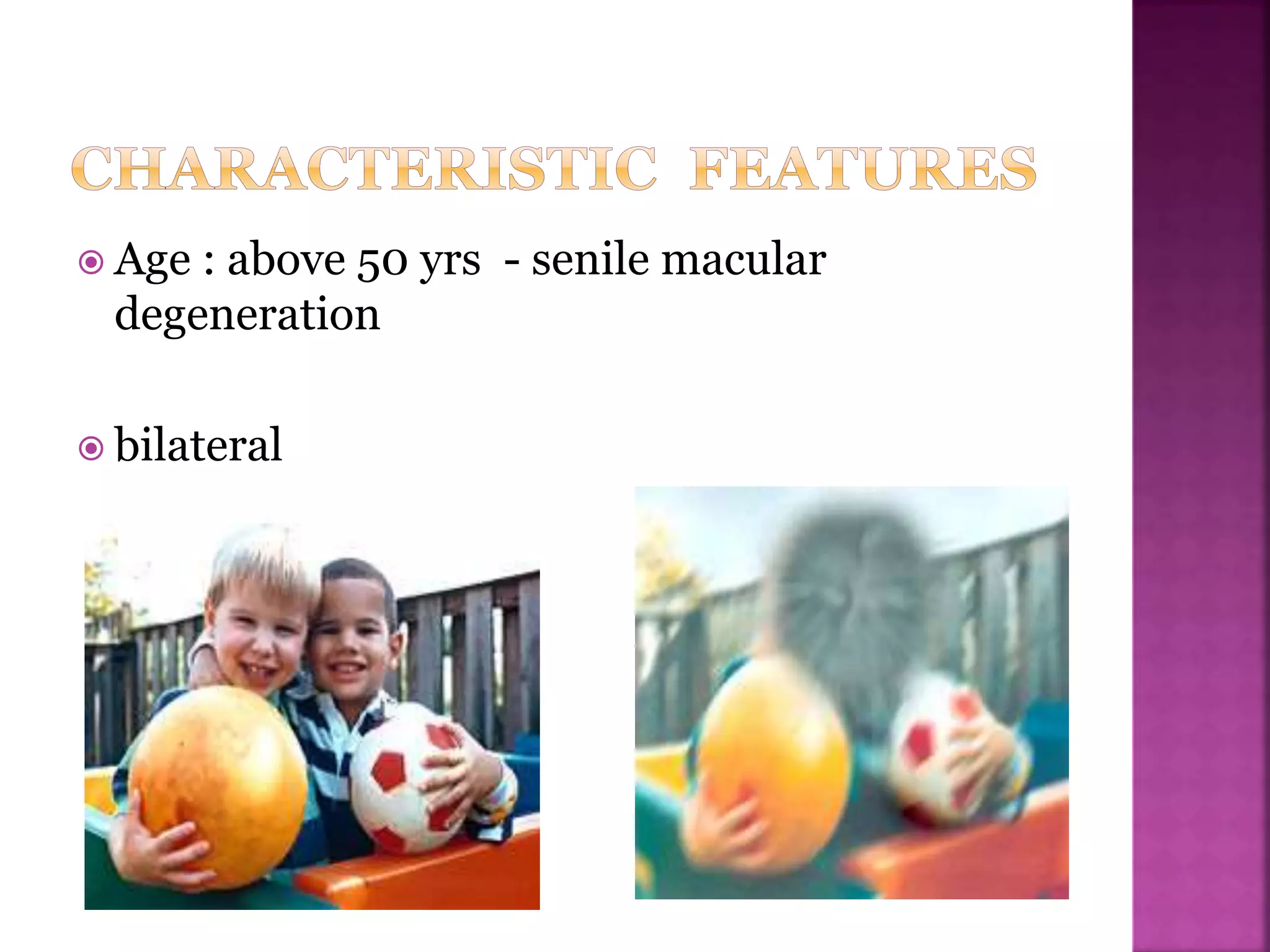 Age related macular degeneration | PPTX