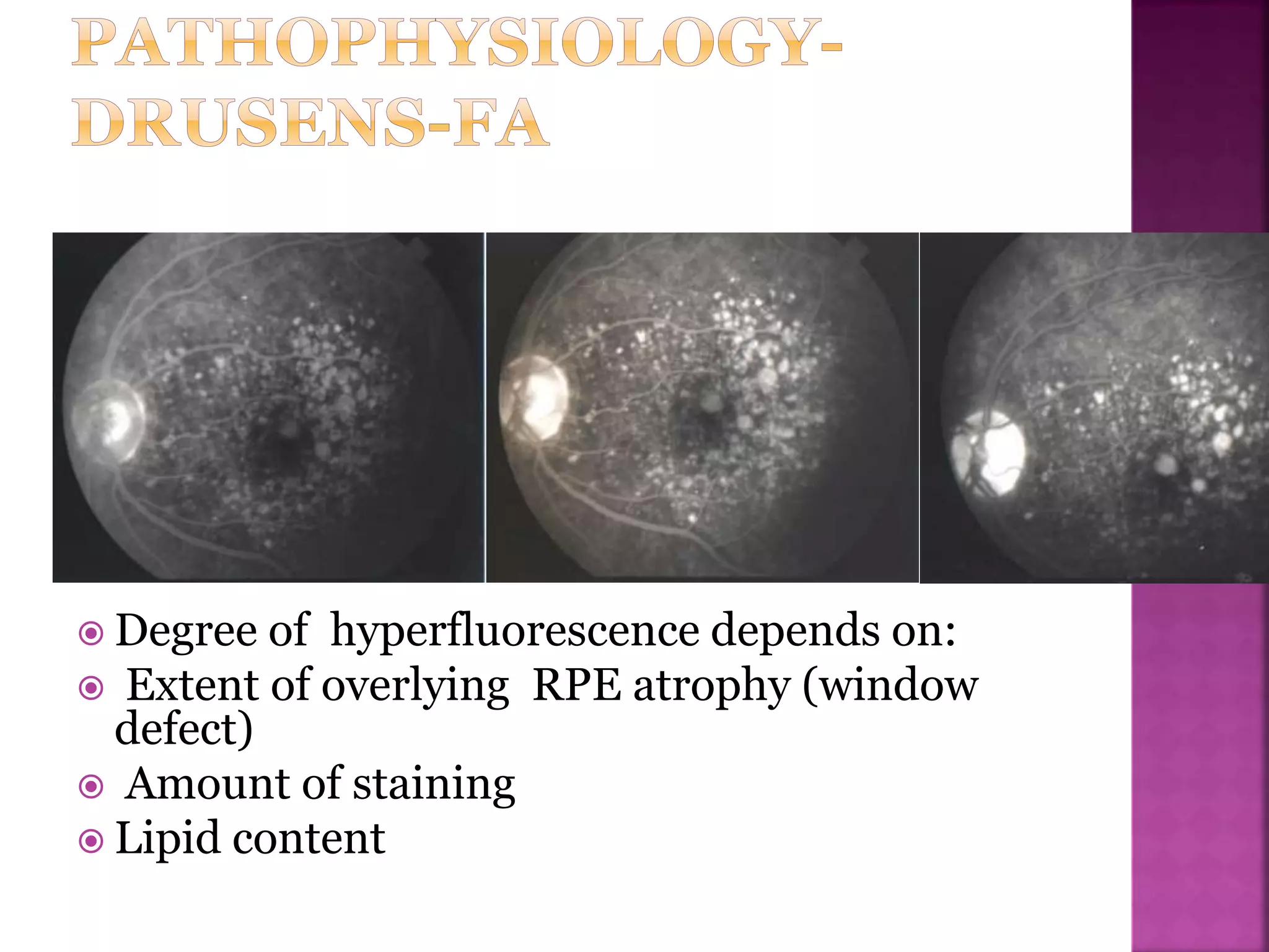 Age related macular degeneration | PPTX