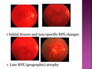 Age related macular degeneration | PPTX